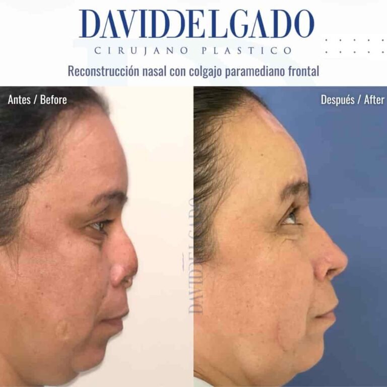 Rinoplastia en Medellín, Estética y Funcional | Dr David.